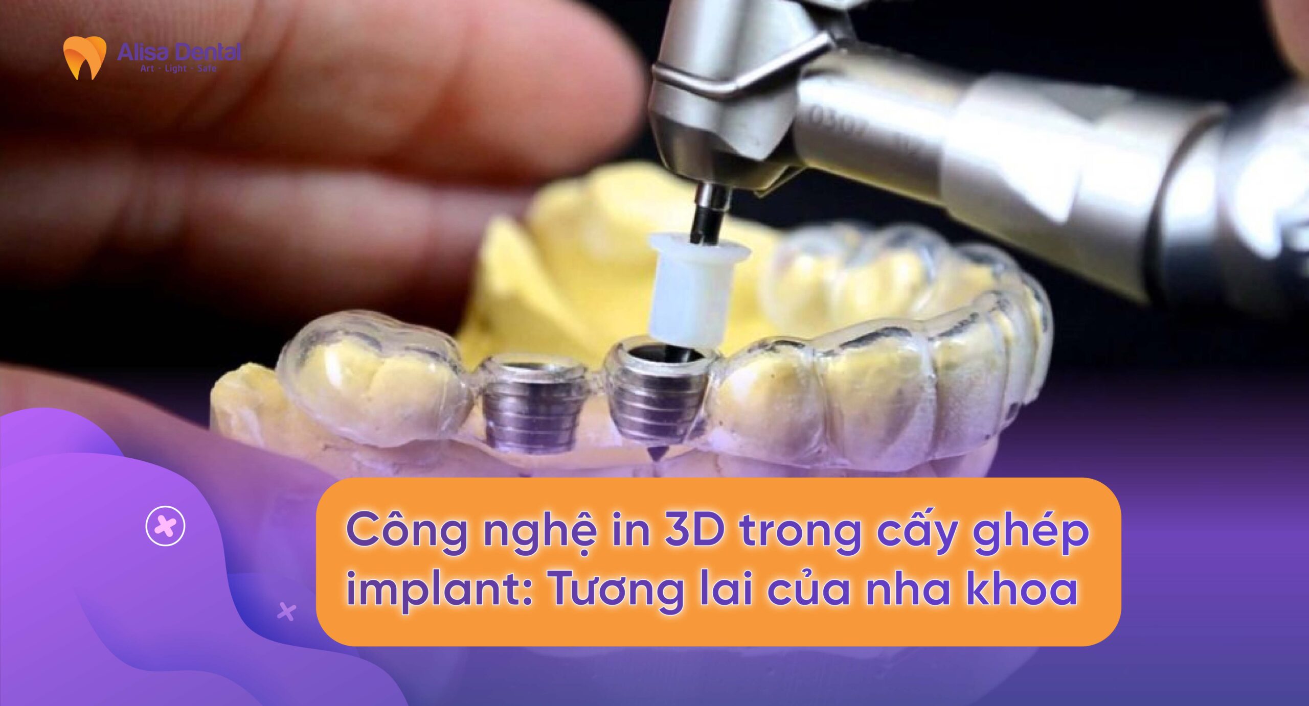 Công nghệ in 3D trong cấy ghép implant: Tương lai của nha khoa