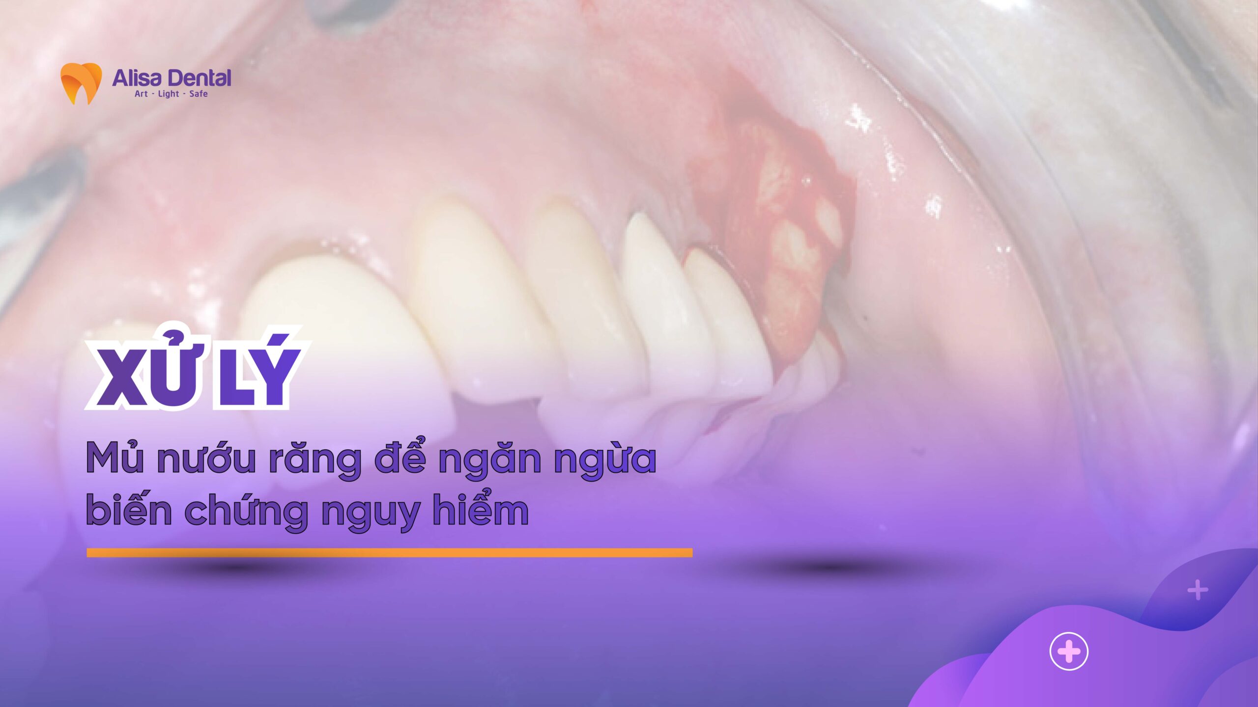 Xử lý mủ nướu răng để ngăn ngừa biến chứng nguy hiểm