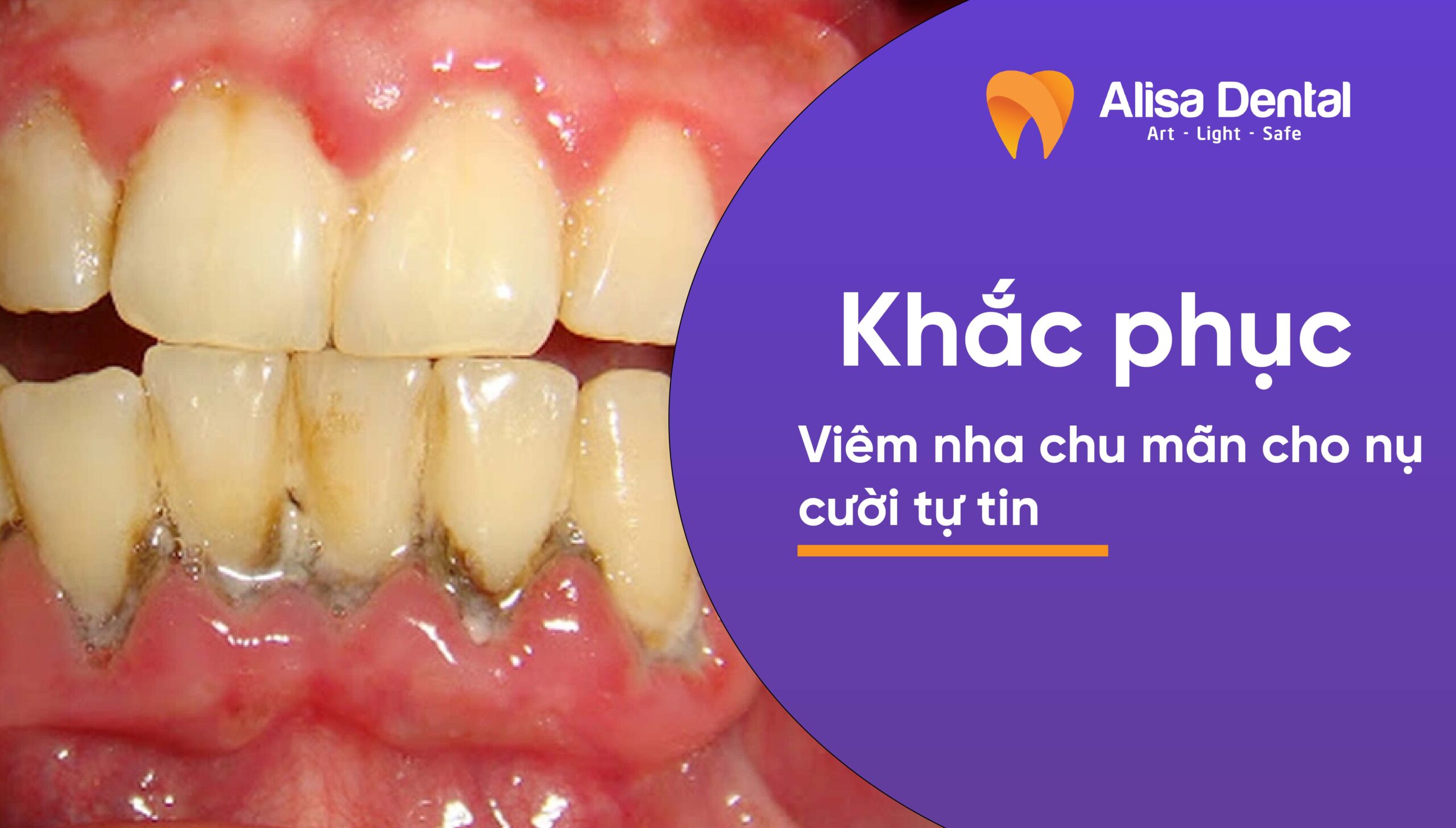Khắc phục viêm nha chu mãn cho nụ cười tự tin